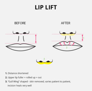 Lip Lift - The Jacobs Center for Cosmetic Surgery
